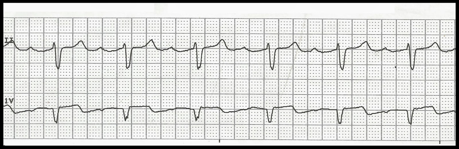 Practice EKG Rhythm Strips 229