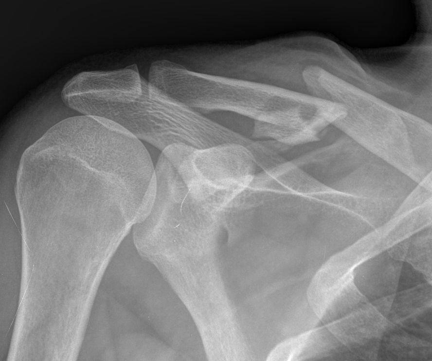 CORACOIDES: Clavicula-pseudo