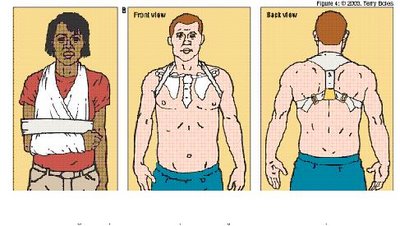 Penatalaksanaan patah tulang selangka / fraktur klavikula | Medianers