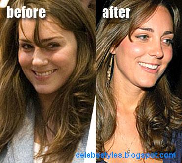 Kate Middleton Surgery before and after:Celebrity Cosmetic Surgeon