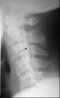 MRI MEDIC CASE STUDIES COLLECTION: Ossification of the posterior ...