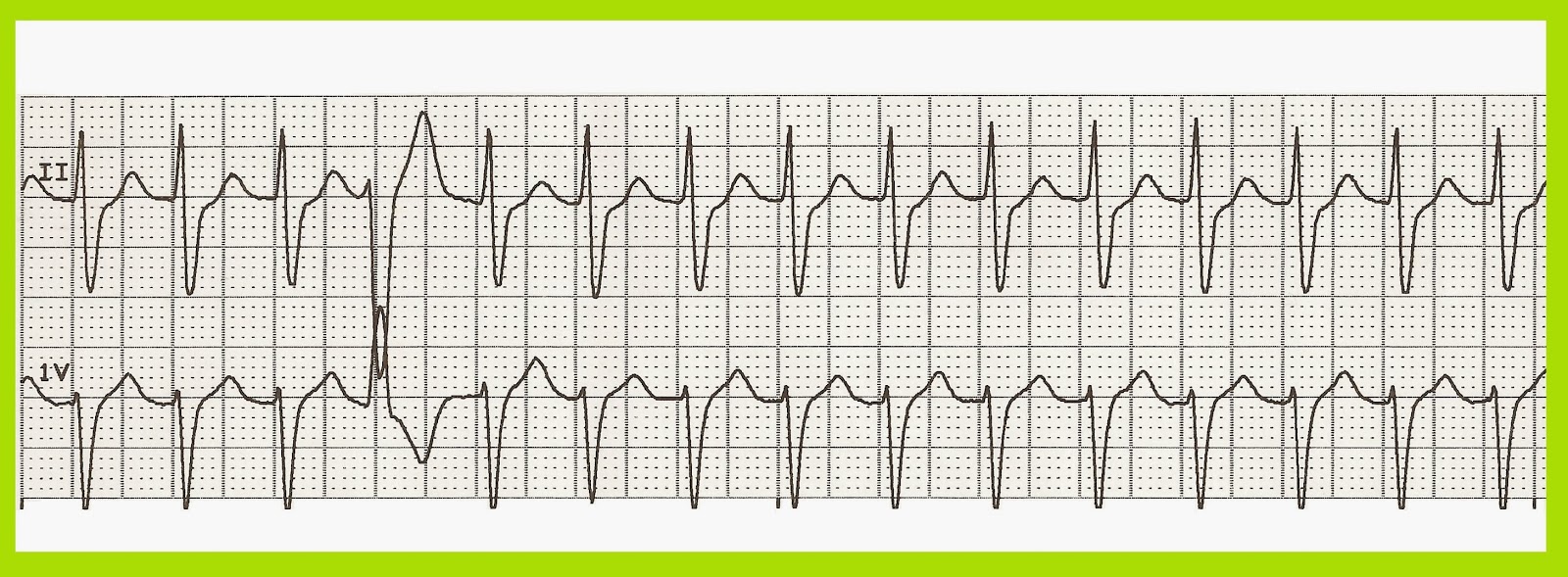 Practice Rhythm Strips 254