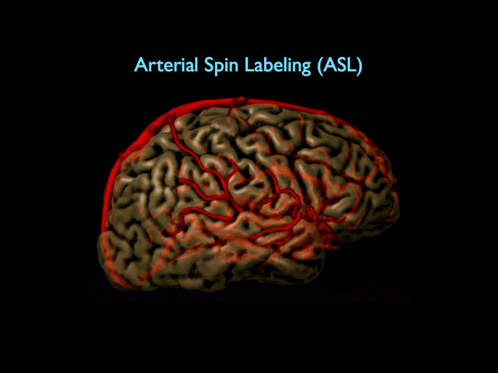 MRI BLOG: Arterial Spin Labeling (ASL)