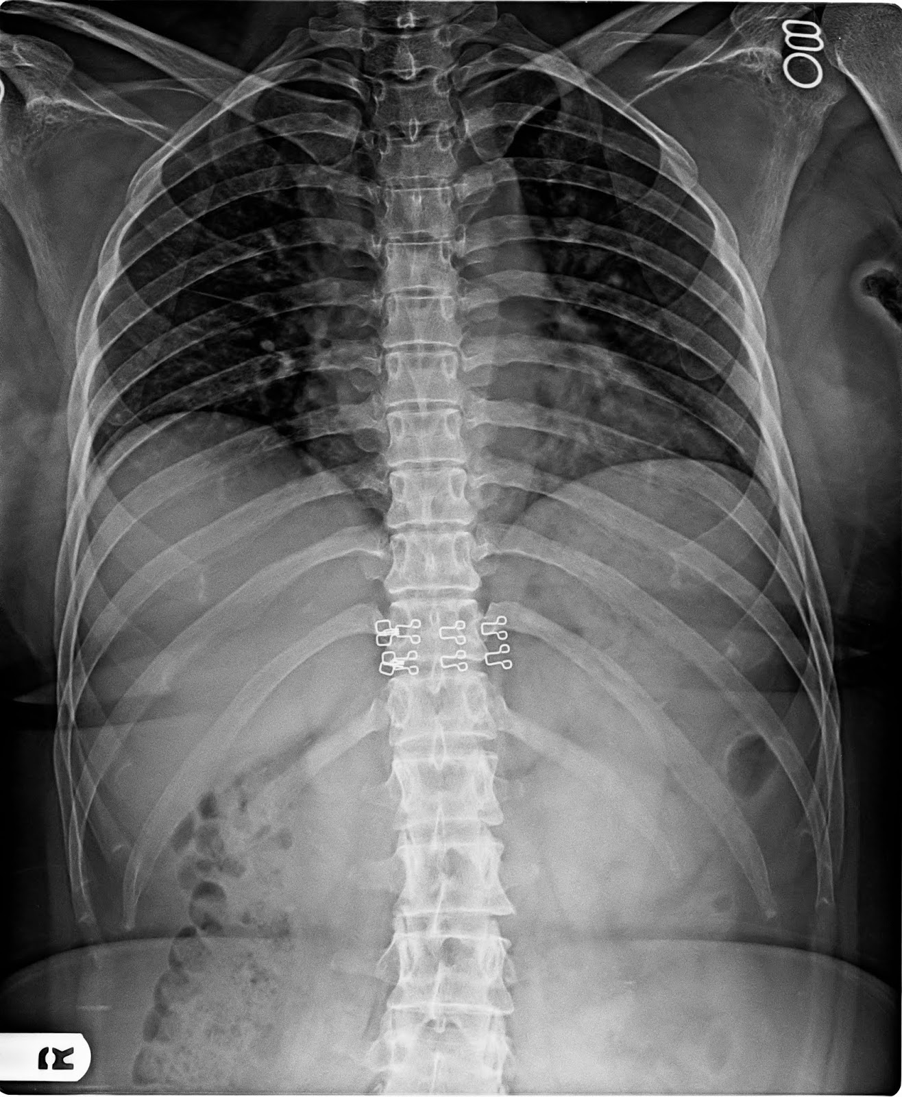 ASTHACARE- SPANDAN IMAGING CENTRE : SONALBEN PATEL F/39Y D.L SPINE-AP/LAT