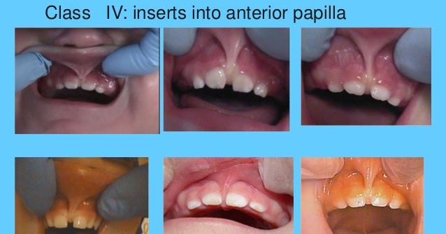 Dentist East Berlin PA: Examples of Lip-Ties
