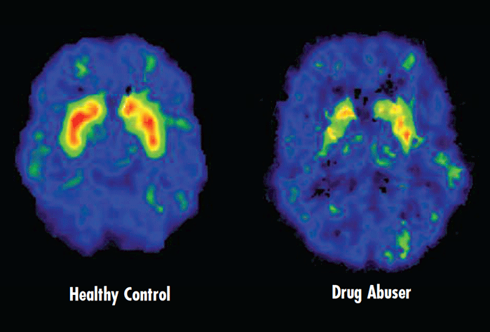 OPIATE EFFECTS ON THE BRAIN AND THE REST OF THE BODY - For Good Life