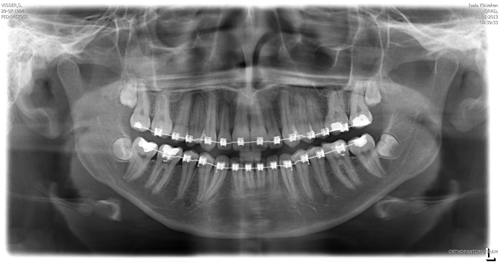 Sharon's kaakoperatie: Röntgenfoto's voor en na de operatie.