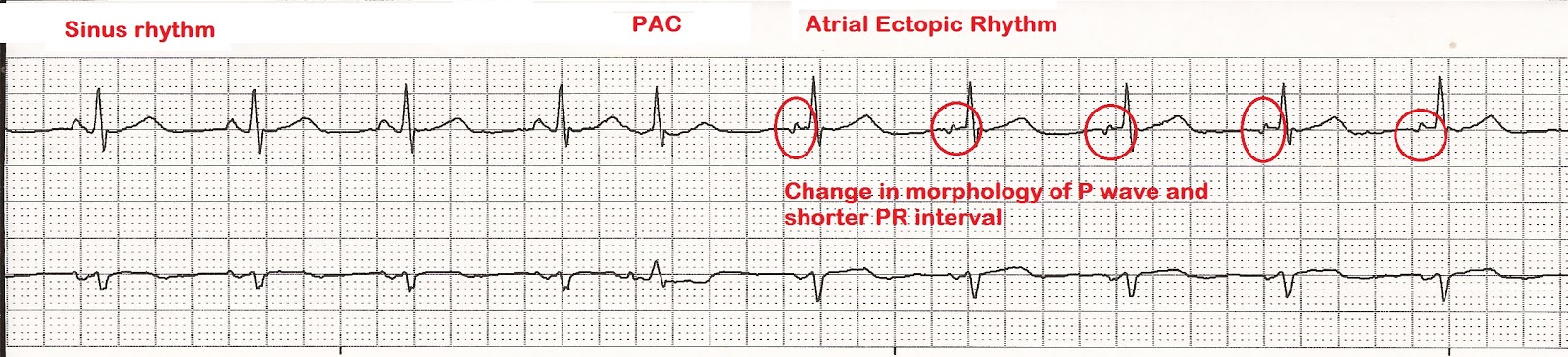 Float Nurse: EKG Rhythm Strips 72