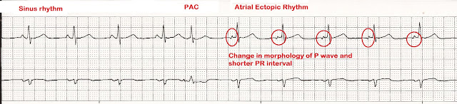 EKG Rhythm Strips 72