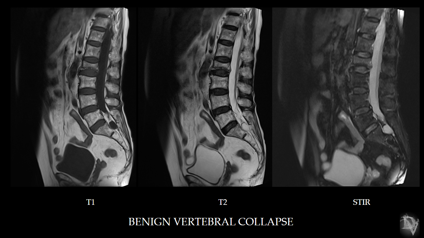 Ultimate Radiology : BENIGN VERTEBRAL COLLAPSE