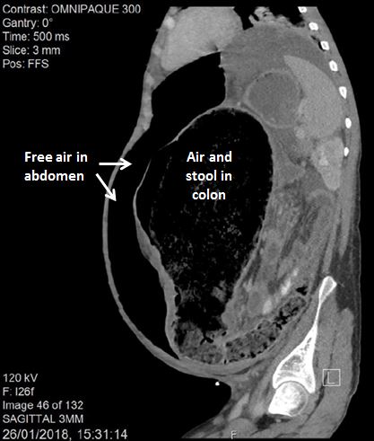 Skeptical Scalpel: A perforated colon case report raises a few issues