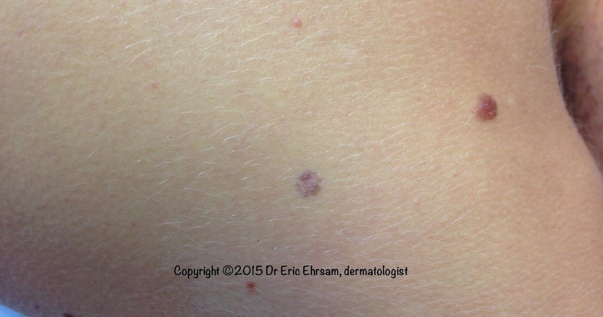 dermoscopy: Regression.