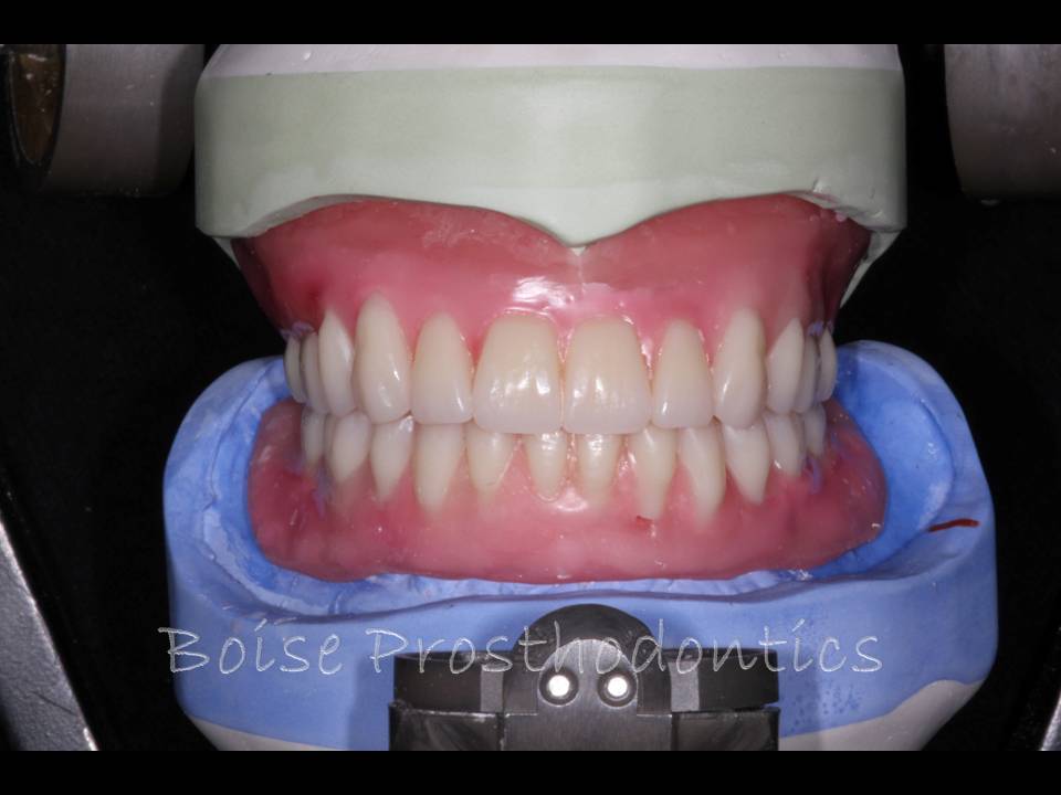 Boise Idaho Prosthodontics: Picture Sequence of Maxillary Complete ...
