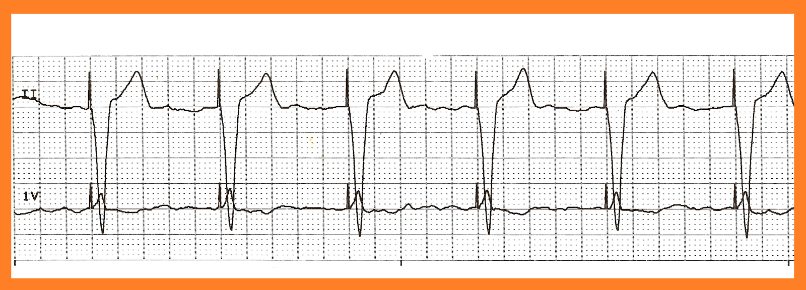 Various Ventricular Paced Rhythms