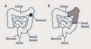 Medical Treatment Pictures-for Better Understanding: Colectomy Surgery ...