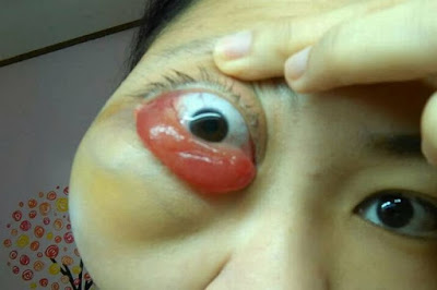 Graphic Photos: Young Woman Who Has Eye Popping Out Of Her Head ...