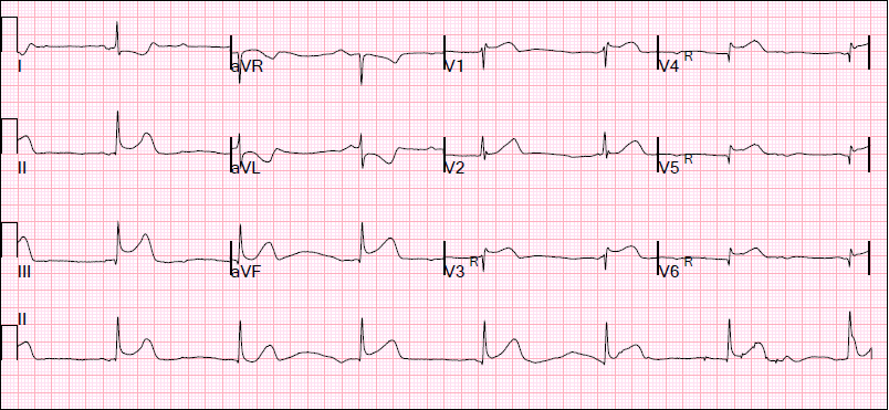Dr. Smith's ECG Blog: Inferior STEMI with AV Block, Cardiogenic Shock ...