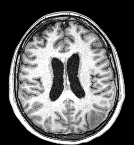 Paralisis de la mirada conjugada