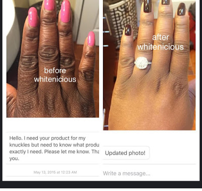 Dencia Before And After