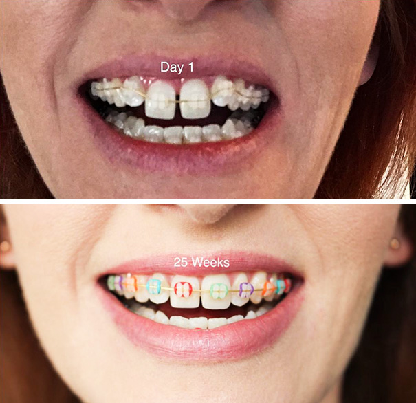 Real World Fatos A Diferença Que Faz Usar Aparelho Nos Dentes 2