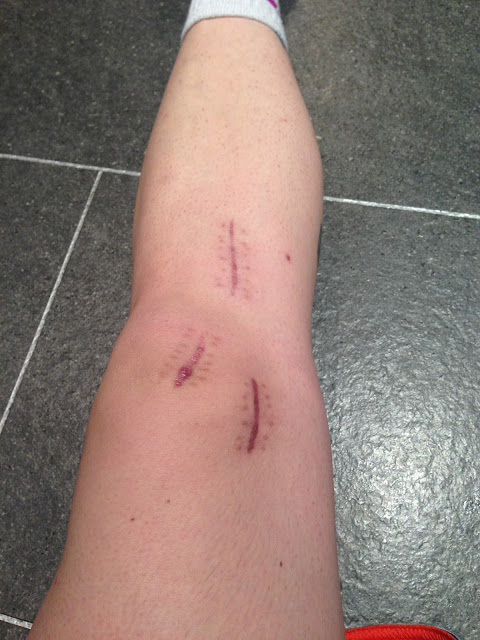 My Experience Having MPFL Reconstruction Surgery