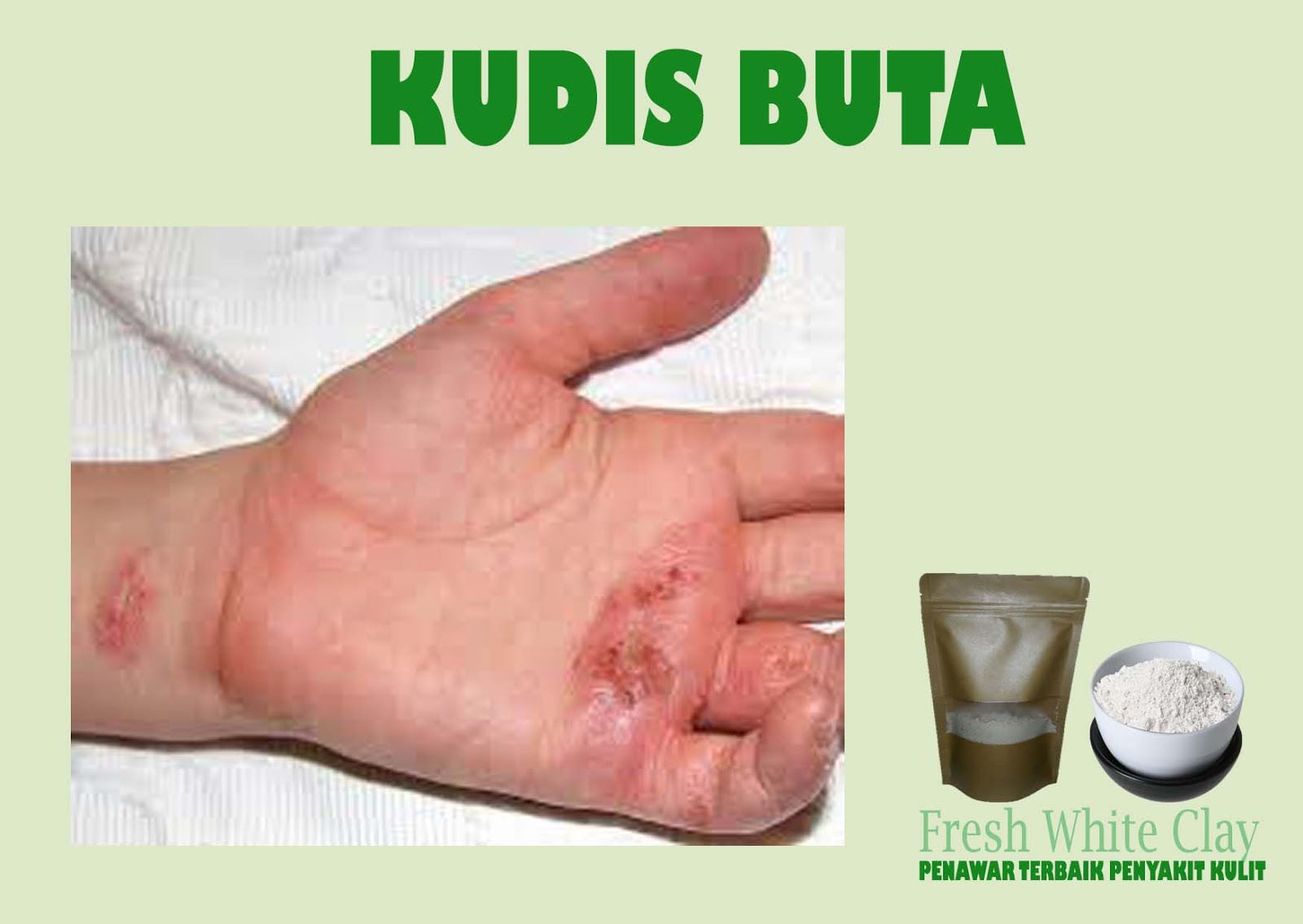 Soleehaa Anggun Beauty: Tips Menghilangkan Kudis Buta dengan Cepat