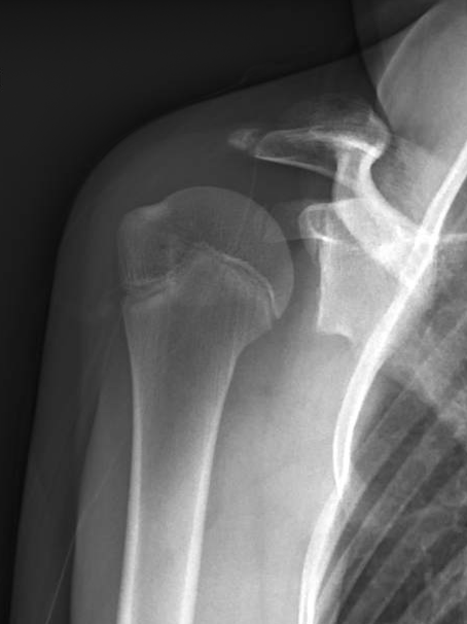 Shoulder and Elbow Surgery: Posterior chondrolabral cleft and recurrent ...