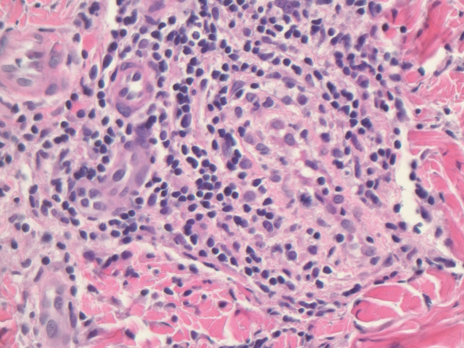 syphilis signs & symptoms ~ infectious diseases