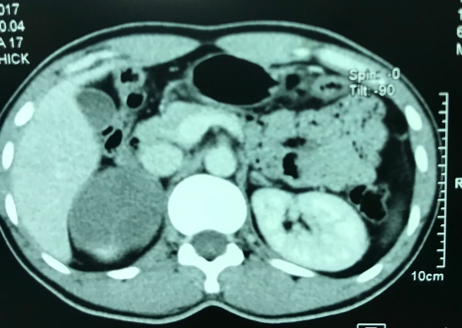 VIETNAMESE MEDIC ULTRASOUND: CASE 468: ADRENAL GLAND TUMOR, Dr PHAN ...