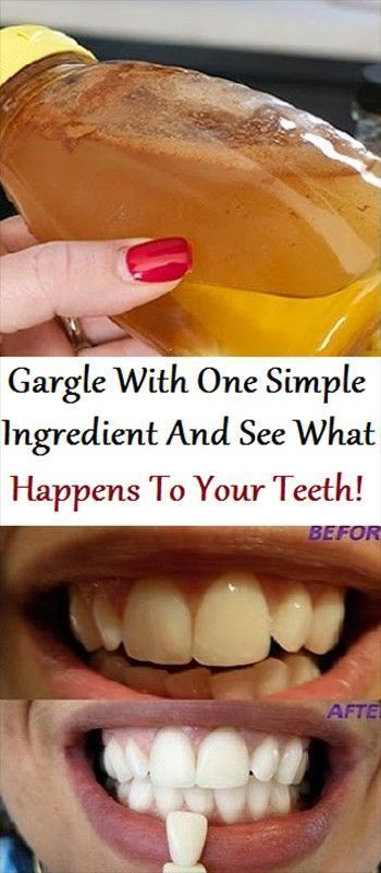 Gargle With One Simple Ingredient And See What Happens To Your Teeth!