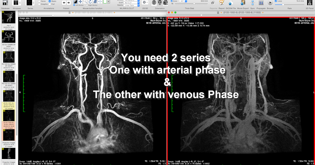 Nevit's blog: How to Create Color MR Angiography using Osirix and Color ...