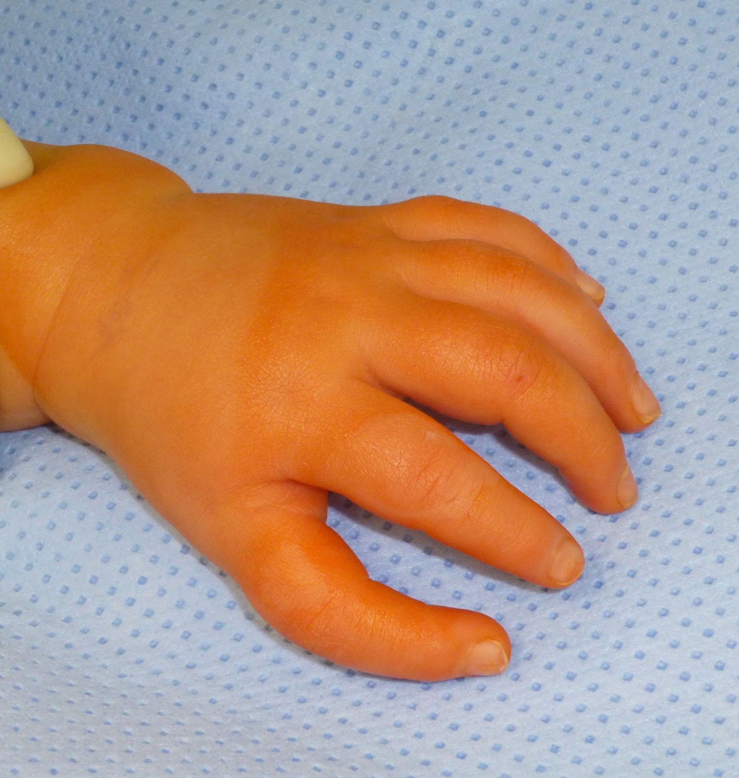 The 5- Finger Hand | Congenital Hand and Arm Differences | Washington ...