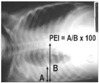 PLEURAL EFFUSION INDEX