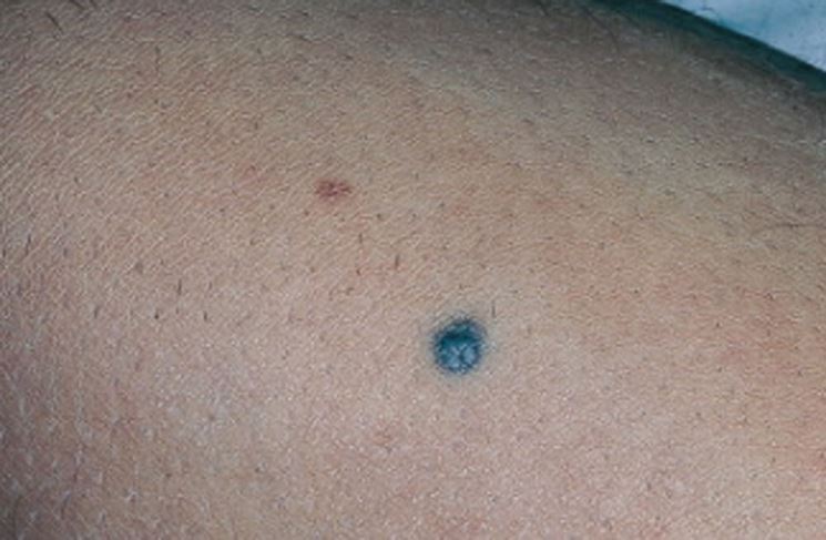 Dermatologo Pisa, Studio Giuseppe Ferrauto : Visite Specialistiche a ...