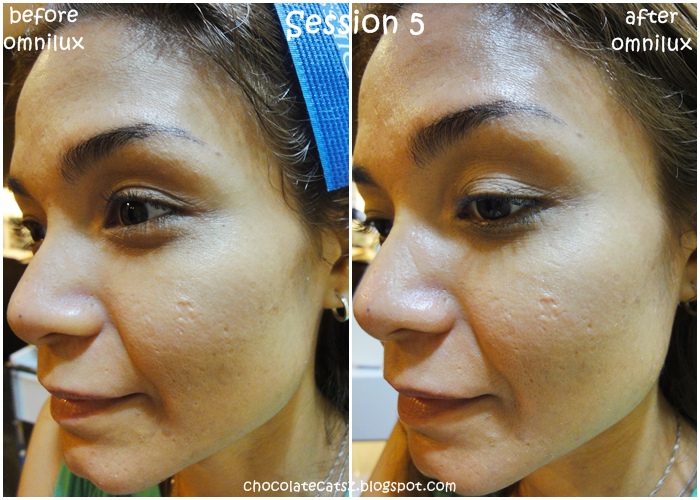 Chocolate Cats: Review: Omnilux - LED Therapy! Great Complexion Made Easy!