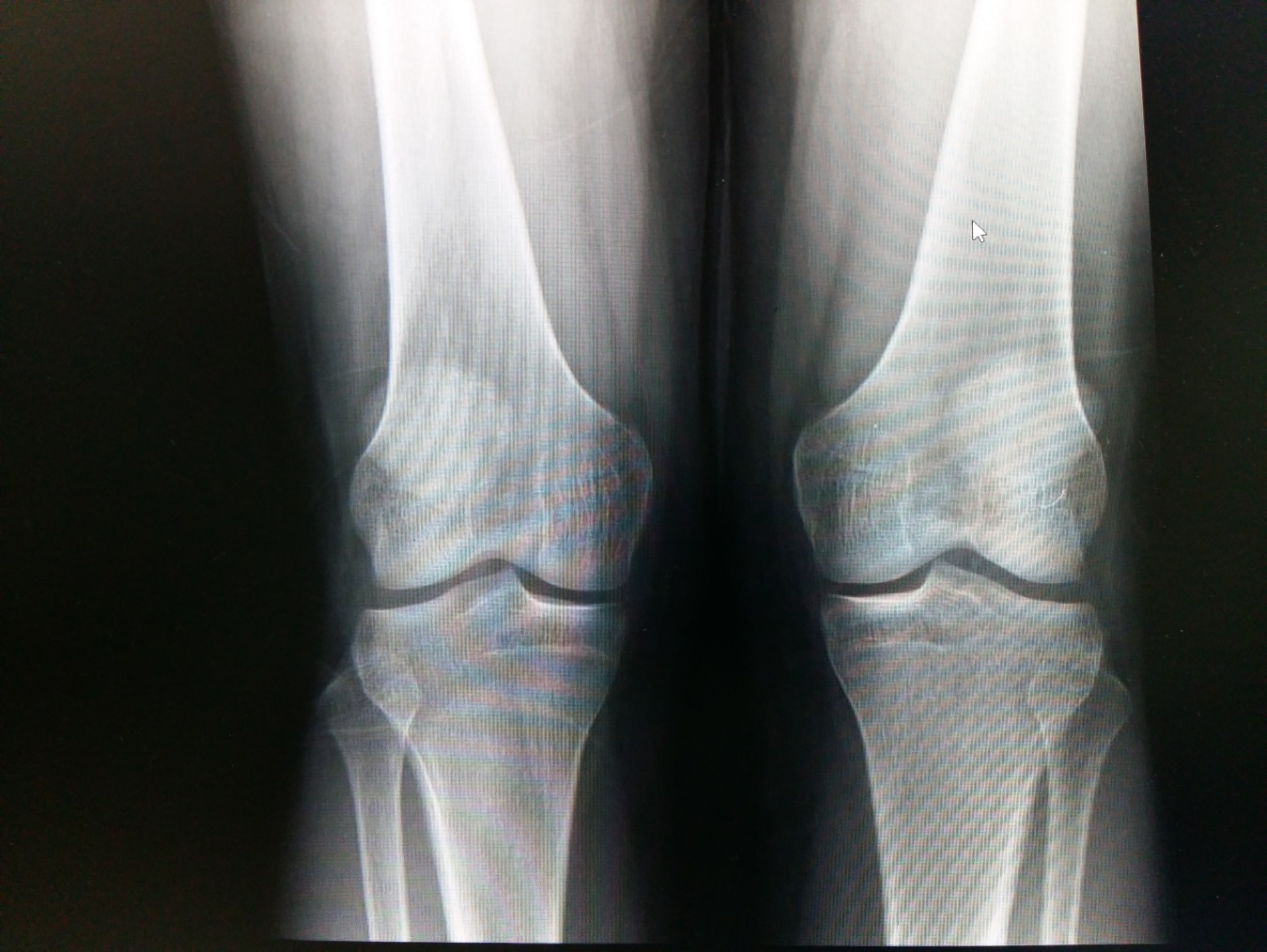 O R T O C R I T I C A: MENISCOPATIA POST TRAUMATICA