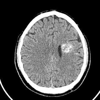 Ultimate Radiology : Multiple Cavernomas in Brain