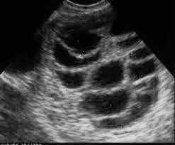 About Ovarian Stimulation ( Superovulation) | The IVF Specialist's Blog ...