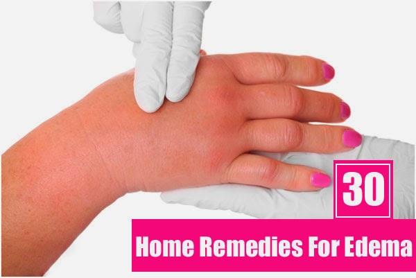 30 Effective Home Remedies For Edema ~ Mzizi Mkavu