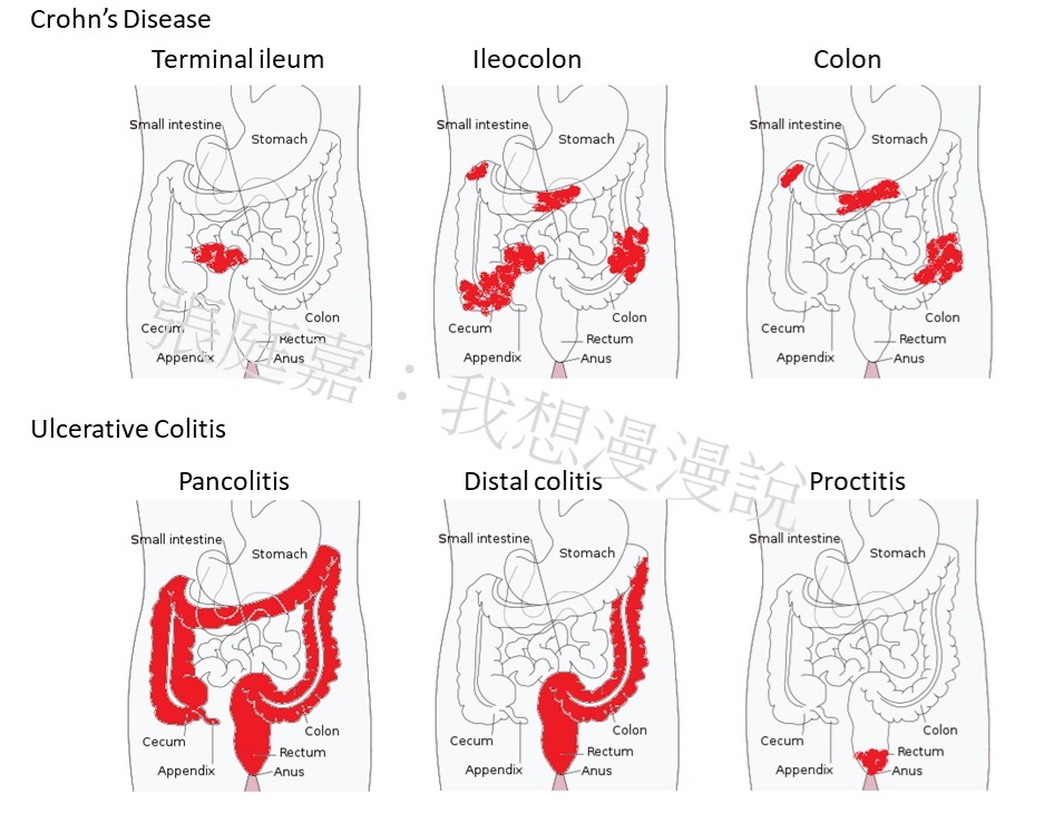 發炎性腸道疾病：克隆氏症(CD)及潰瘍性大腸炎(UC)