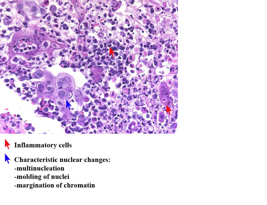 Smart Medical Information: All About Shingles