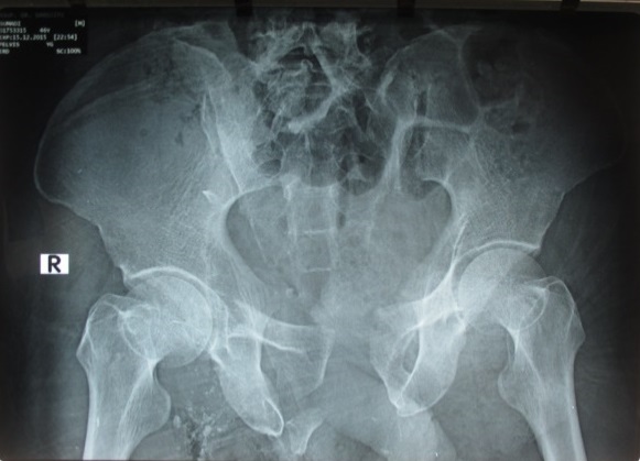 Orthopaedi Knowledges: PELVIC INJURY