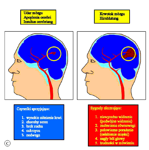 Nasze Ciało: Wylew krwi do mózgu - porada chińskiego profesora