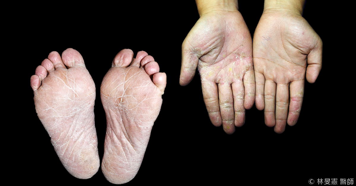 林旻憲醫師- 醫膚當關: 皮膚科醫師幫您看手相、保健康