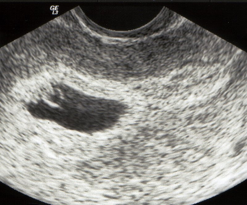 Ms. Adventures in Fertility Land: 1st Ultrasound 5w2d