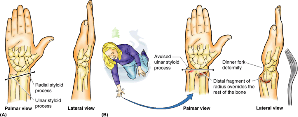 SAMARPAN PHYSIOTHERAPY CLINIC: DINNER FORK DEFORMITY & PHYSIO EXERCISE