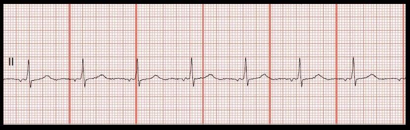 Various Accelerated Junctional Rhythms