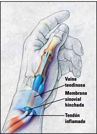 Enfermedades profesionales, un enemigo silencioso.: Tenosinovitis de ...