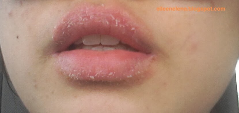 Everyday is a new Starting Point : Health Awareness #1 : Unusual Eczema ...