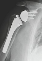 Ortopedia: Prótese de Ombro